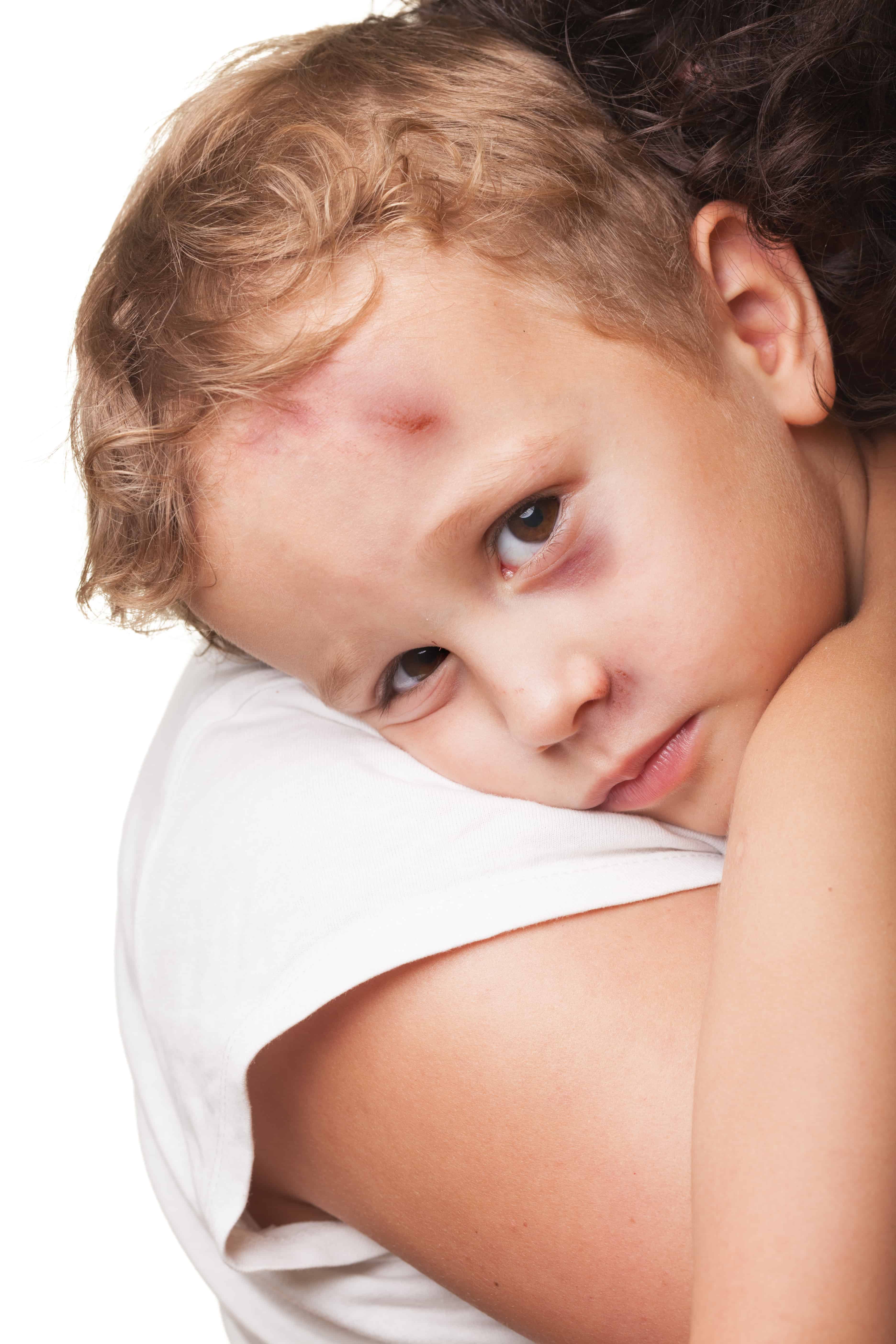 Concussion Symptoms And CTE A Quick Look Hospitality Health ER
